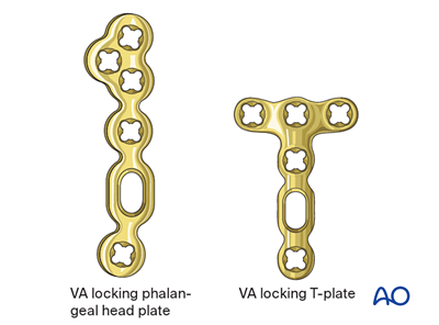 Compression plating with a lateral plate for Transverse extraarticular ...