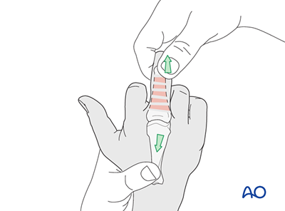 Compression plating with a lateral plate for Transverse extraarticular ...