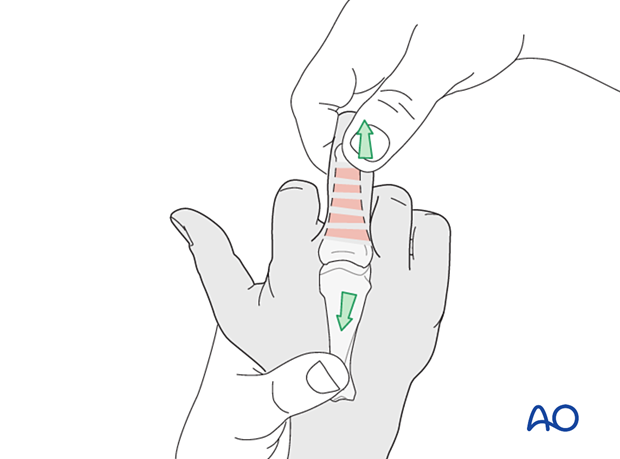 K Wire Fixation For Transverse Extraarticular Fracture Of The Proximal