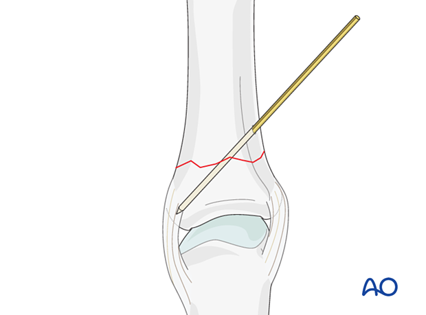 Compression Plating With A Lateral Plate For Transverse Extraarticular