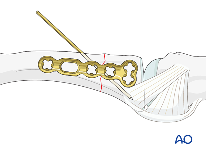 Compression plating with a lateral plate for Transverse extraarticular ...