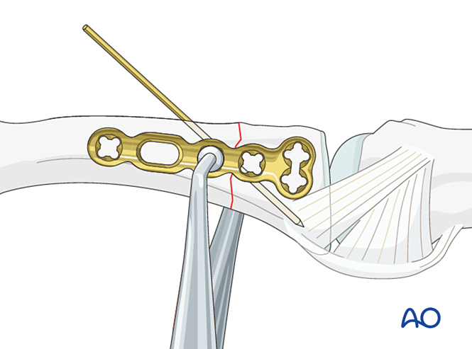 Compression plating with a lateral plate for Transverse extraarticular ...