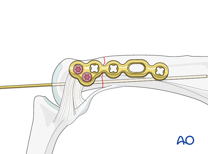 Compression plating with a lateral plate for Transverse extraarticular ...