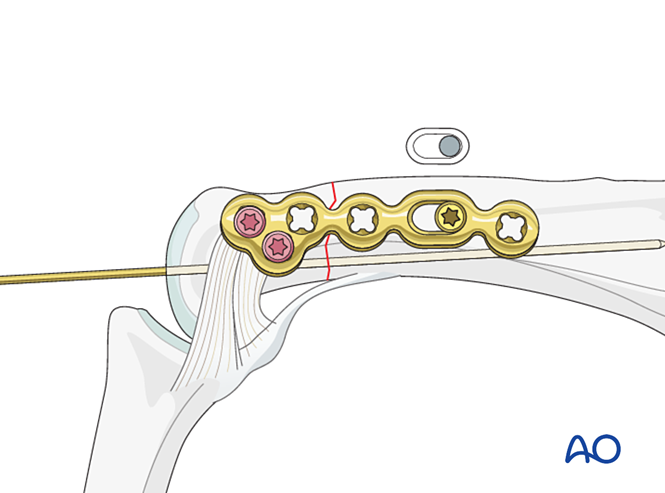 Compression plating with a lateral plate for Transverse extraarticular ...