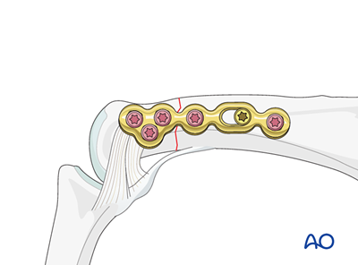Compression plating with a lateral plate for Transverse extraarticular ...