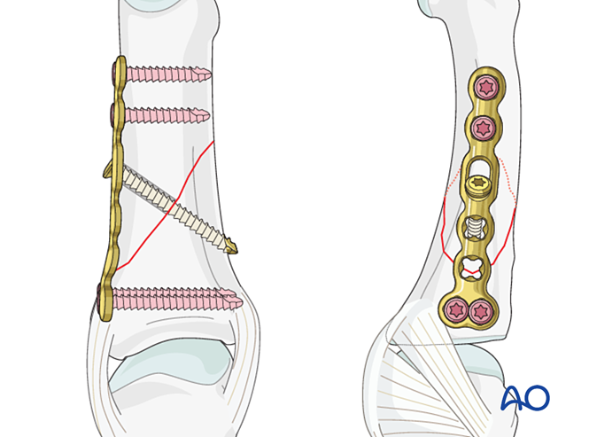 Compression with a lateral plate with or without lag screw for Oblique ...