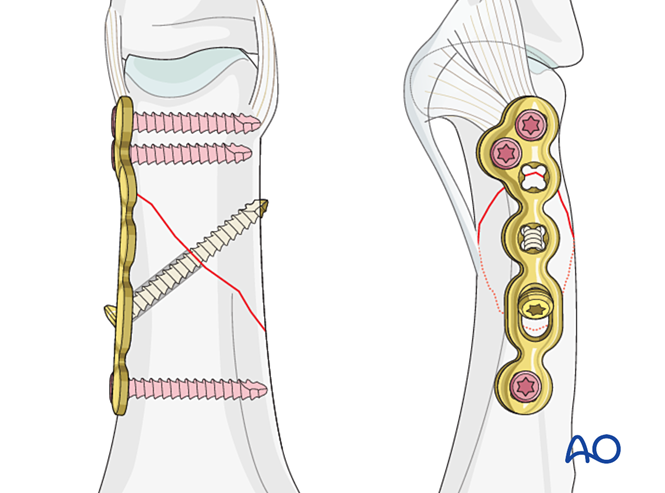 Compression with a lateral plate with or without lag screw for Oblique ...