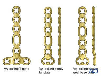 Compression with a lateral plate with or without lag screw for Oblique ...