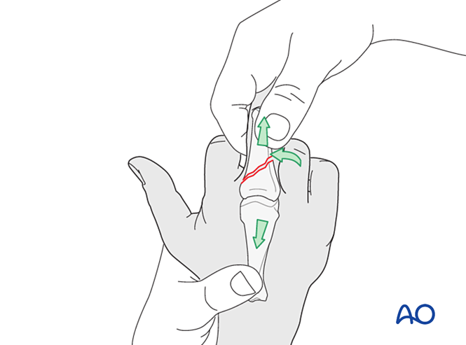 Compression with a lateral plate with or without lag screw for Oblique ...