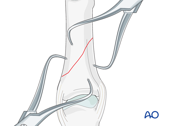Compression with a lateral plate with or without lag screw for Oblique ...