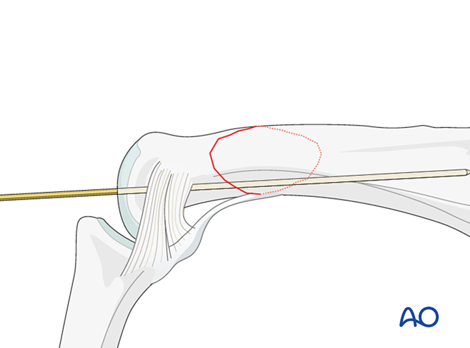 Compression with a lateral plate with or without lag screw for Oblique ...