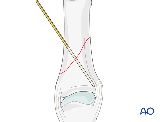 Compression with a lateral plate with or without lag screw for Oblique ...