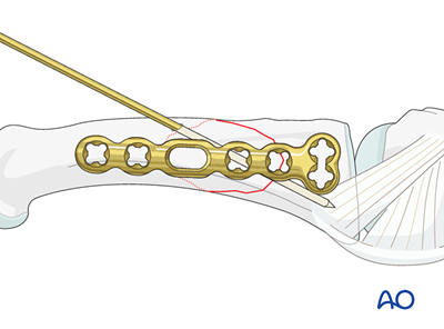 Compression with a lateral plate with or without lag screw for Oblique ...