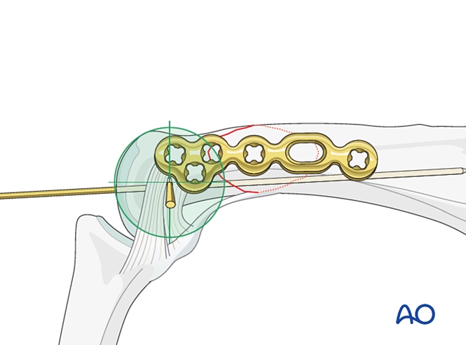 Compression with a lateral plate with or without lag screw for Oblique ...