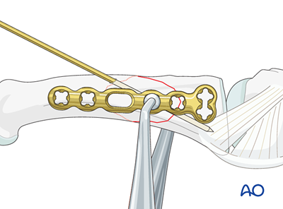 Compression with a lateral plate with or without lag screw for Oblique ...