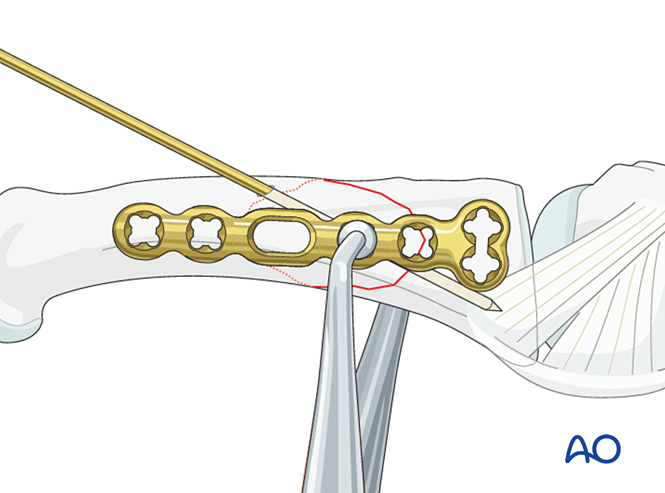 Compression with a lateral plate with or without lag screw for Oblique ...