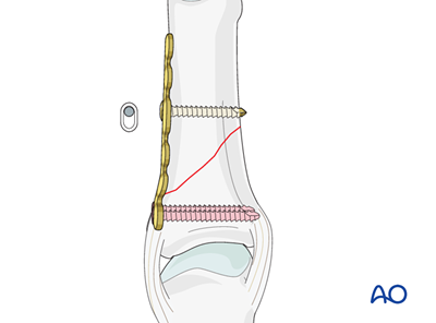 Compression with a lateral plate with or without lag screw for Oblique ...