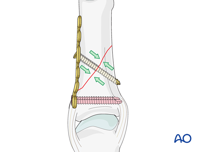 Compression with a lateral plate with or without lag screw for Oblique ...