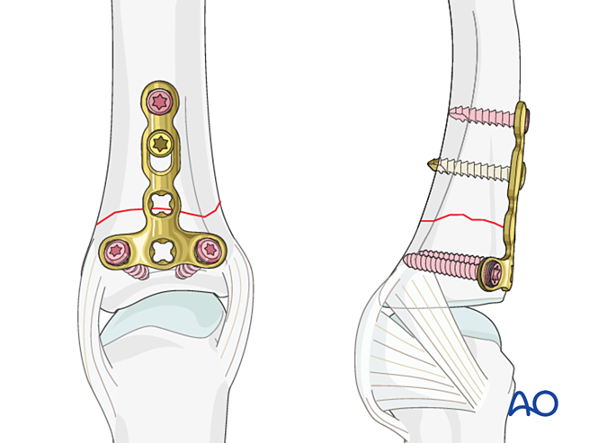 Compression plating with a dorsal T-plate for Transverse extraarticular ...