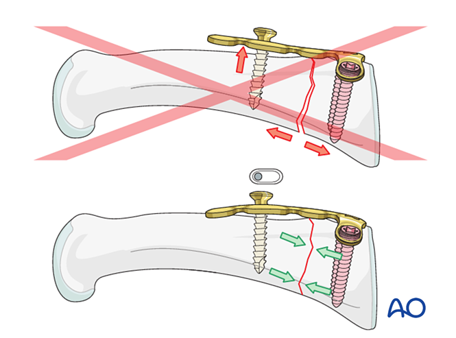 Compression plating with a dorsal T-plate for Transverse extraarticular ...