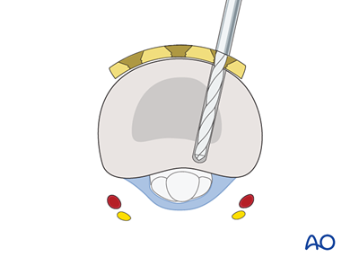 Bridge plating for Wedge/multifragmentary fracture of the diaphysis