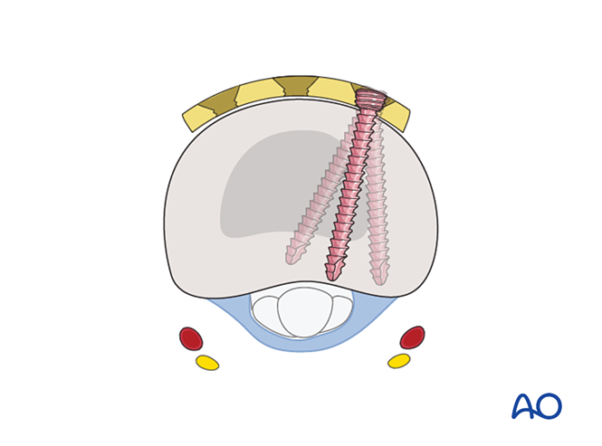 Compression plating with a dorsal T-plate for Transverse extraarticular ...