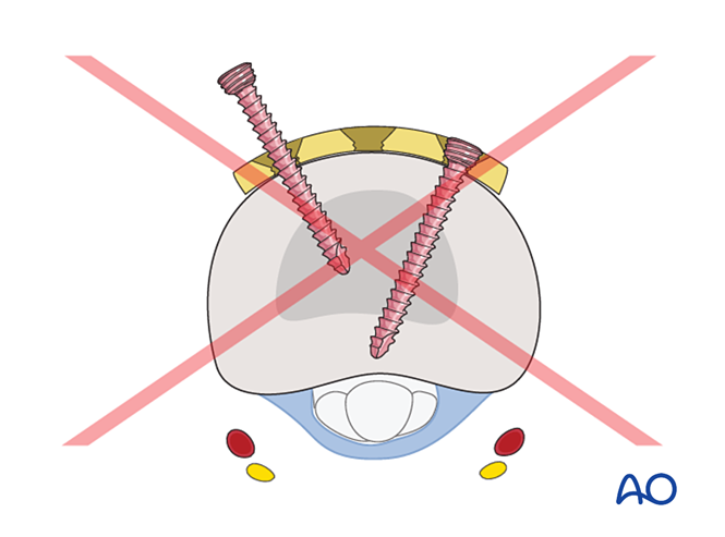 Compression plating with a dorsal T-plate for Transverse extraarticular ...
