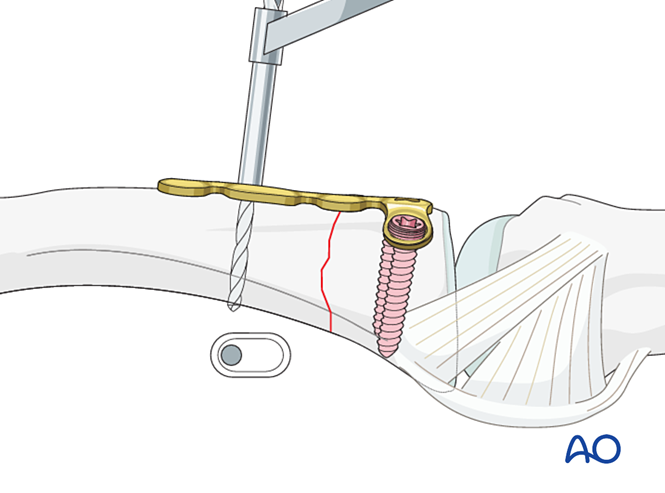 Plating with a dorsal T-plate for Complete articular fracture of the ...