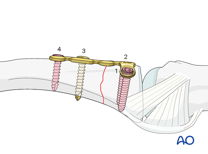 Compression plating with a dorsal T-plate for Transverse extraarticular ...