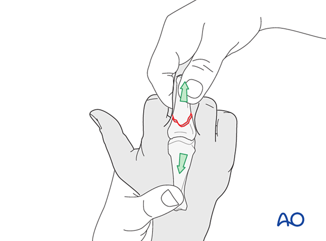 Lag-screw fixation with a neutralization plate for Oblique ...