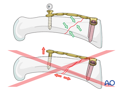 Compression with a dorsal T-plate with or without lag screw for Oblique ...