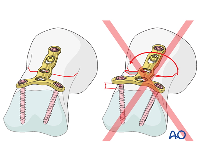 Compression with a dorsal T-plate with or without lag screw for Oblique ...