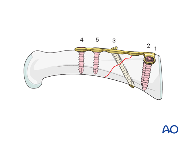 Compression with a dorsal T-plate with or without lag screw for Oblique ...