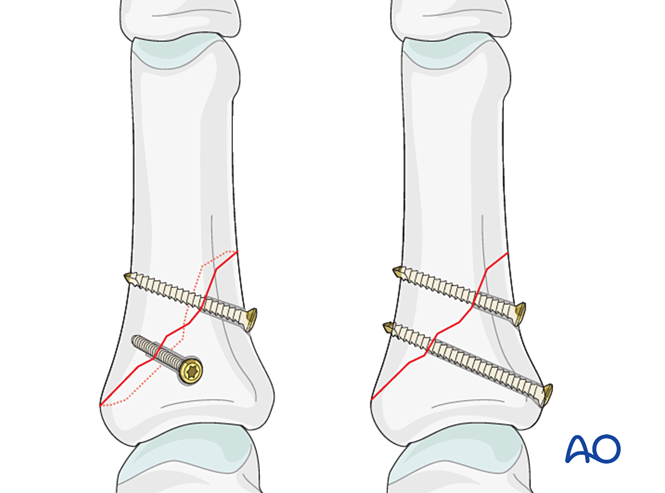 Lag-screw fixation for Oblique extraarticular fracture of the proximal ...