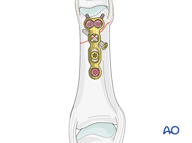 Lag Screw Fixation For Oblique Extraarticular Fracture Of The Distal