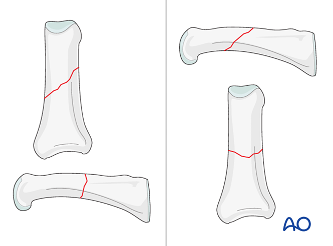 Compression plating for Oblique fracture of the diaphysis