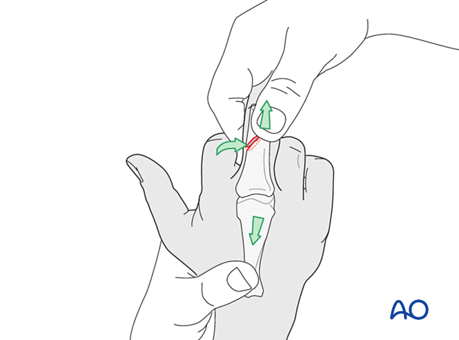 K Wire Fixation For Oblique Extraarticular Fracture Of The Distal End