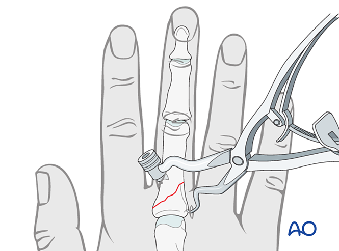 Lag-screw fixation for Oblique extraarticular fracture of the proximal ...