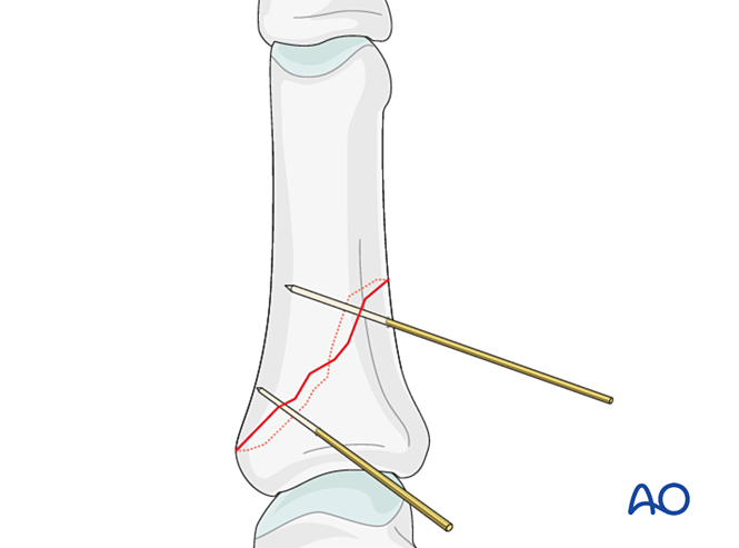 Lag-screw fixation for Oblique extraarticular fracture of the proximal ...
