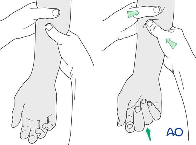 K Wire Fixation For Oblique Extraarticular Fracture Of The Distal End