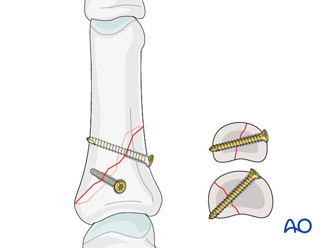 Lag-screw fixation for Oblique extraarticular fracture of the proximal ...