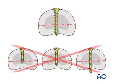 Lag-screw fixation with a neutralization plate for Oblique fracture of ...