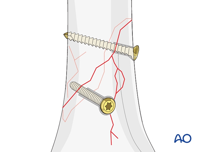 Lag-screw fixation for Complete articular fracture of the distal end ...