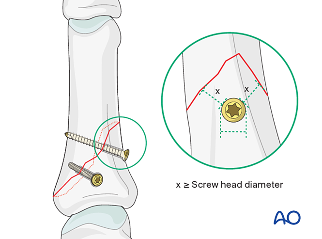 Lag-screw fixation for Oblique extraarticular fracture of the proximal ...