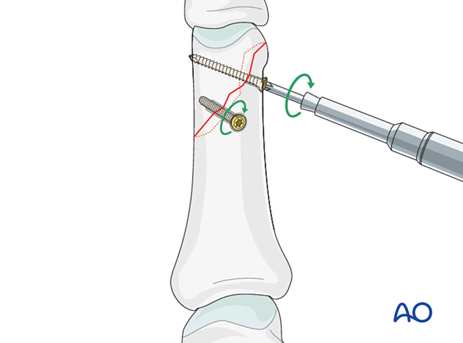 Lag-screw fixation for Oblique extraarticular fracture of the distal ...