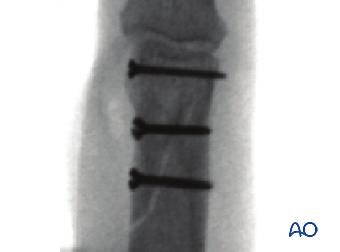 Lag-screw fixation for Oblique extraarticular fracture of the distal ...