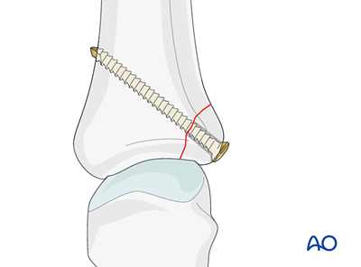 Lag-screw fixation for Avulsion at the proximal end segment