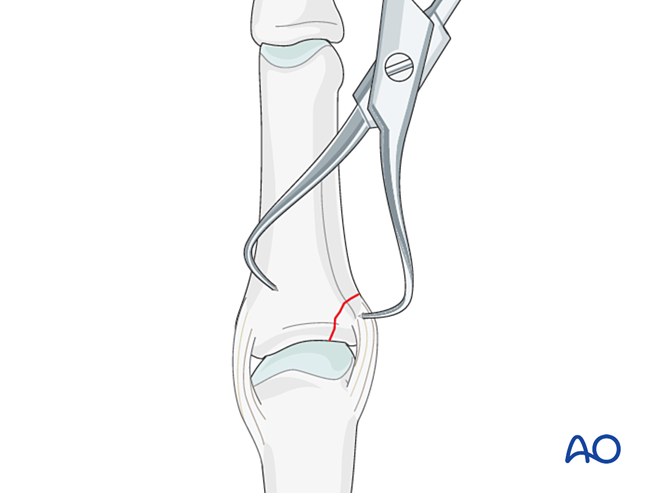 Lag-screw fixation for Avulsion at the proximal end segment