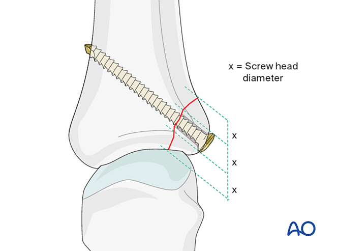 Lag-screw fixation for Avulsion at the proximal end segment