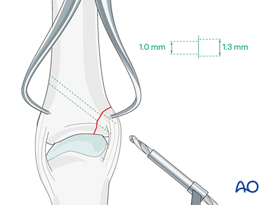 Lag-screw fixation for Avulsion at the proximal end segment